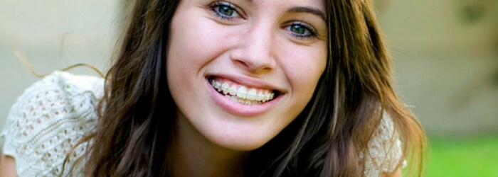 Brackets estéticos: precios, ventajas y tipos