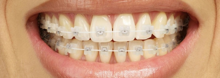 Brackets estéticos: precios, ventajas y tipos