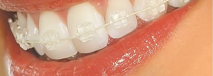 Brackets estéticos: precios, ventajas y tipos