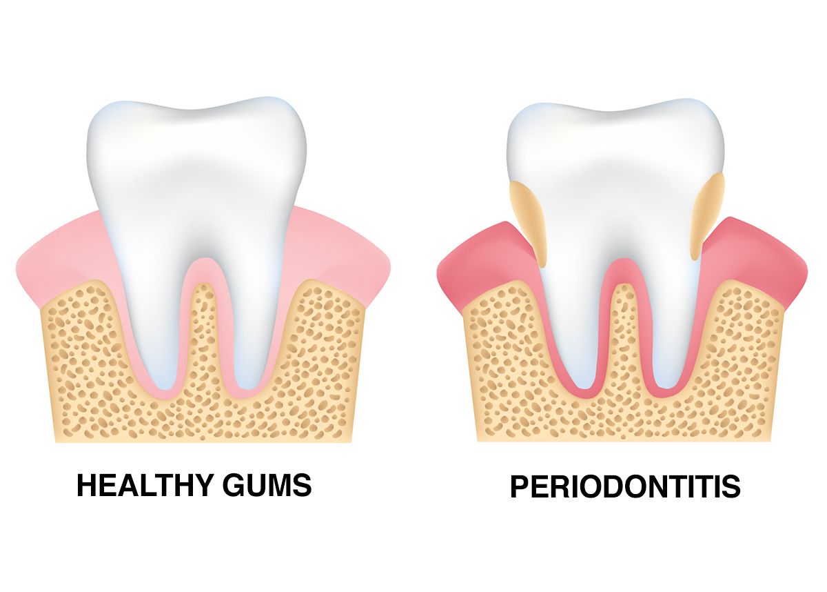 Periodontitis: causas, síntomas y tratamiento