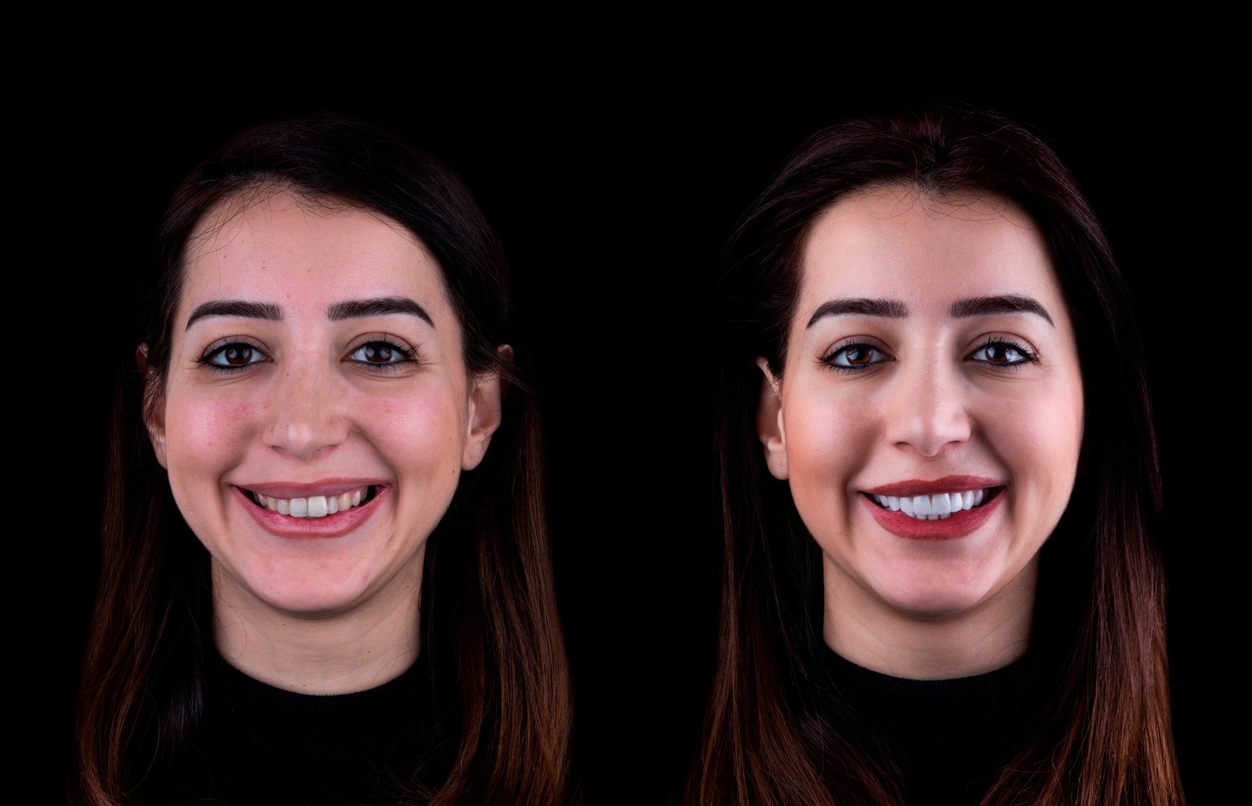¿Cómo es el proceso del diseño de sonrisa?
